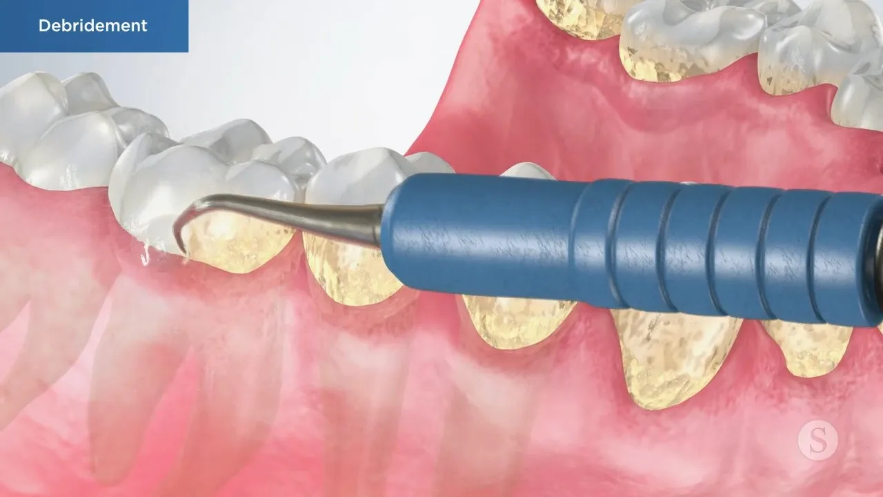 Deep Teeth Cleaning San Francisco | Scaling & Root Planing