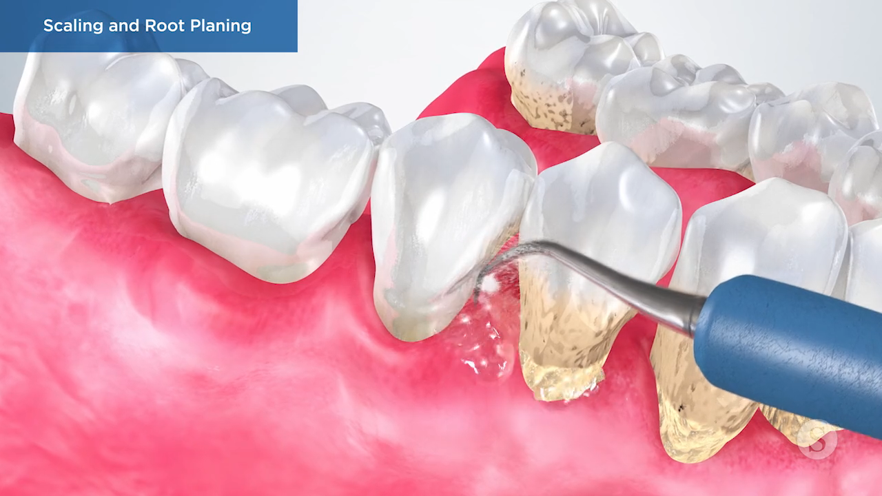 Deep Teeth Cleaning San Francisco | Scaling & Root Planing